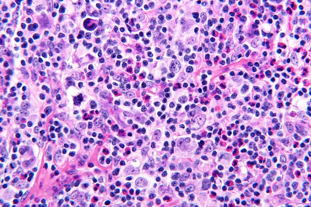 Cutaneous involvement in classic Hodgkin lymphoma – McKee Derm