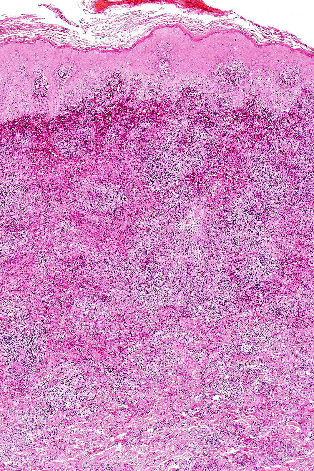 Extranodal NK/T cell lymphoma, nasal type – McKee Derm